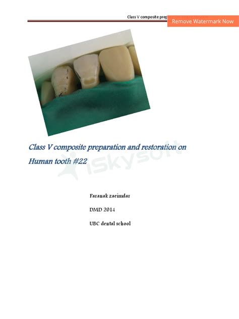 Class V Composite Preparation And Restoration On Human Toothpdf Pdf Dental Composite Dentistry