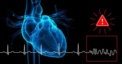 Ahmad Asghar On Linkedin Decoding Arrhythmias Ecg Data Analysis And Dimensionality Reduction