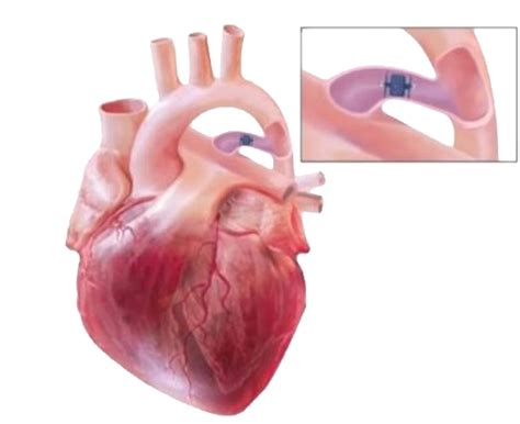 Amplatzer Piccolo Occluder