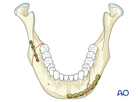 Oblique Line Of Mandible