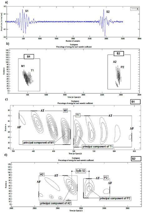 Analysis By The Continuous Wavelet Transform Of A Pcg Normal Signal