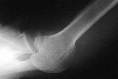 Shoulder Dislocation X Ray Orthobullets At Lori Novak Blog