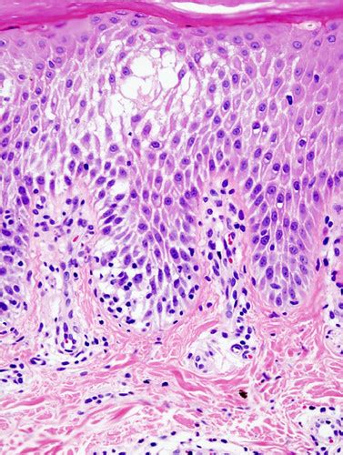 Spongiotic Dermatitis Histopathology High Mag Dyshidrot