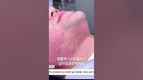 젠틀맥스프로플러스 남자 얼굴전체수염제모 20250318 수원 원스의원 남자제모 수염제모 수원남자제모 수원수염제모 젠틀맥스프로플러스 수원젠틀맥스프로플러스 Youtube