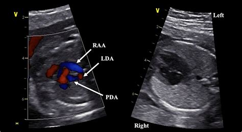Frontiers Case Report And Literature Review Fetal Diagnosis Of