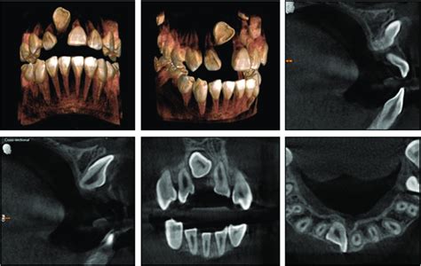 Pre Treatment Cone Beam Computed Tomography Cbct Download Scientific Diagram
