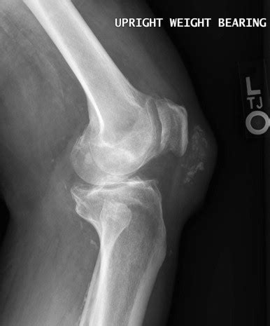 Gout Knee Xray