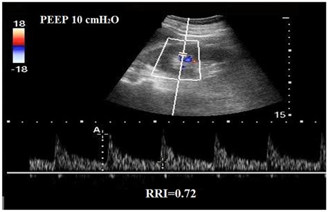 A Representative Renal Resistivity Index Measurement Technique