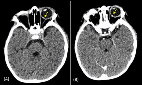 Axial Ct Scan Of The Orbits Non Contrast A And Contrast Enhanced