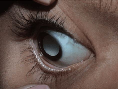 Hookworm In Human Eye