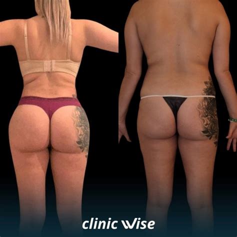 Safe Bbl Before After Clinic Wise