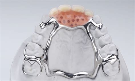 Metal Partial Denture Sydney Denture Clinic