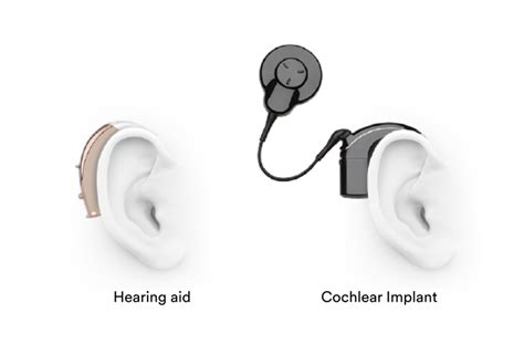 How Cochlear Implants Work