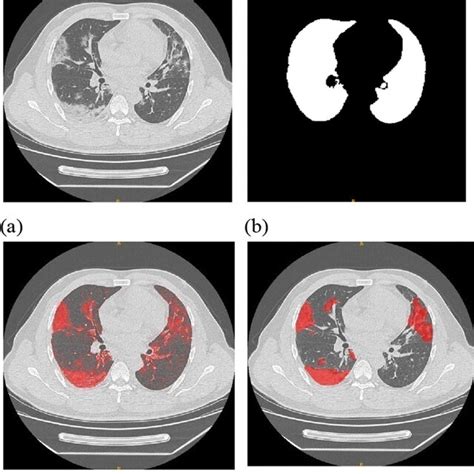 typical hu based pseudo labeled and manually labeled ct images a