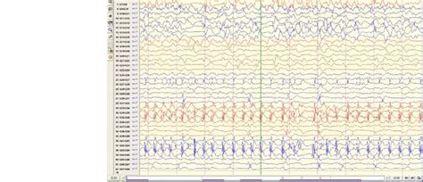 Subdural Grid Eeg Recording Showing Near Continuous Epileptiform Download Scientific Diagram