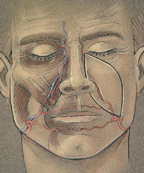56 Nasolabial Flaps For Oral Cavity Reconstruction Medicine Libretexts