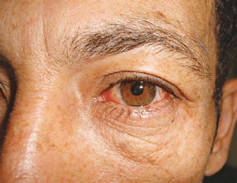Eye Inflammation Ophthalmological Evaluation Revealed Bilateral