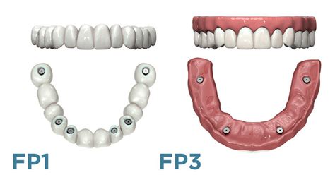 Fp1 Dental Treatment What It Is And Why It Matters