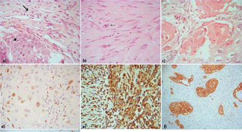 Recurrent Tumor A Sarcomatous Arrow And Epithelial Component Arrow