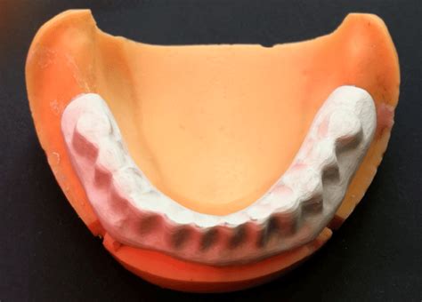 Final Biohpp Telescopic Overdenture Framework Download Scientific Diagram