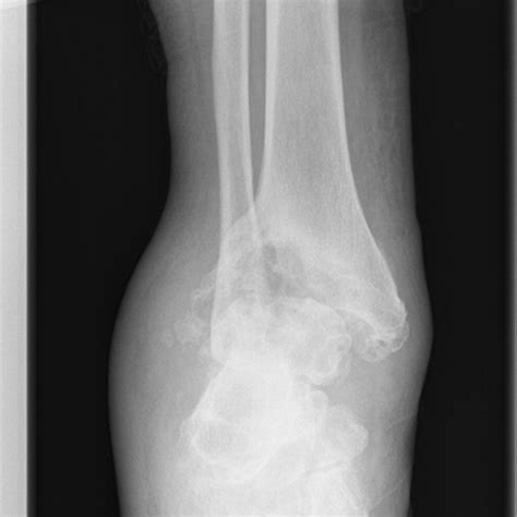 Pdf Treating Segmental Bone Defects A New Technique