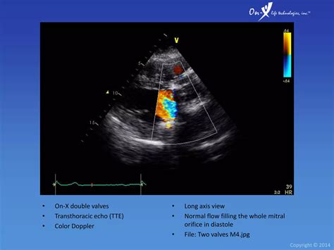 On X Heart Valve Echocardiography Pptx