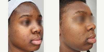 Salicylic Peel Before And After Pictures Realself