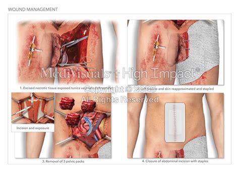 Wound Management Medivisuals High Impact