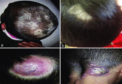 Clinical Variants Of Tinea Capitis Seen In Our Study A Grey Patch
