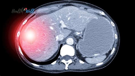 What Size Of Liver Cyst Is Dangerous Make My Health Well