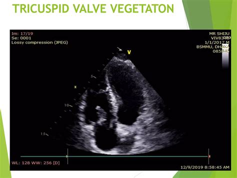 Infective Endocarditis Echo Dr Khaled Ppt