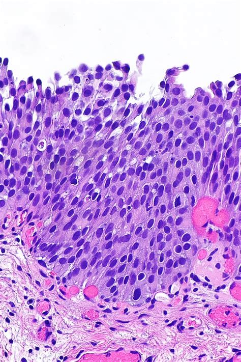 Urothelial Dysplasia Libre Pathology