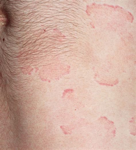 Urticaria Angioedema And Pruritus Clinical Tree