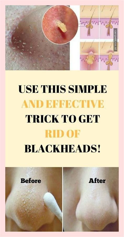 Remove Blackheads Get Rid Of Blackheads Home Beauty Tips Small Pimples