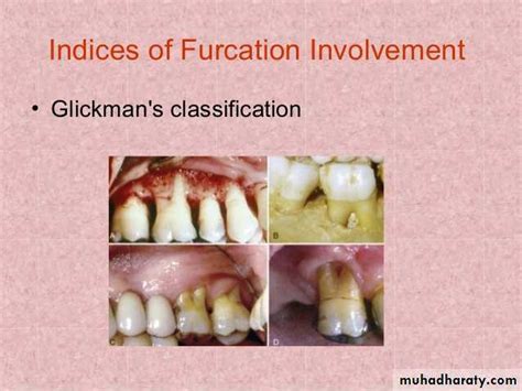 Furcation Involvement Pptx د عمر وليد Muhadharaty