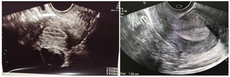 Ultrasonographic Endometrial Classification In In Vitro Fertilization