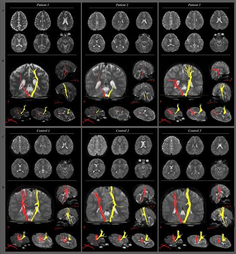 Diffusion Tensor Tractography Of The Corticospinal Tract In Patients