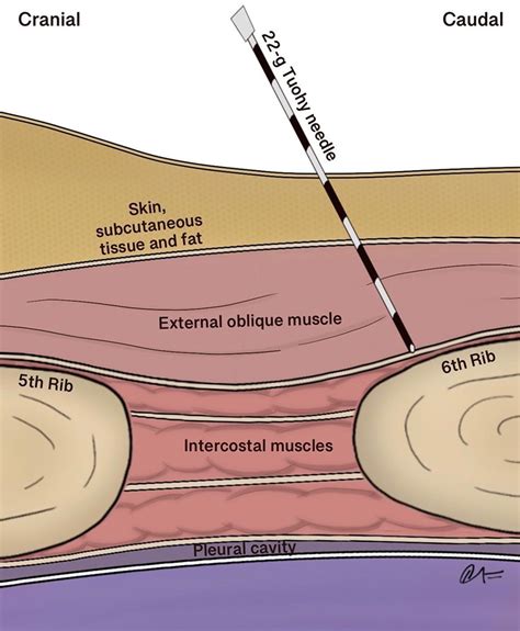 Oblique Plane Anatomy
