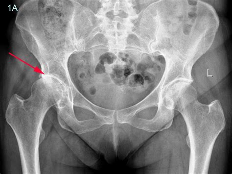 Severe Hip Arthritis