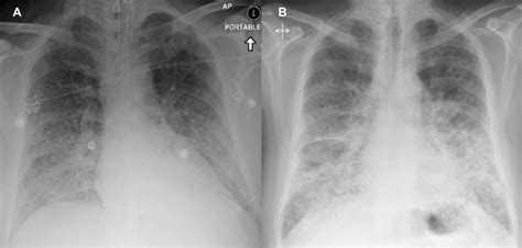 Does Chest X Ray Show Histoplasmosis At Steve Michelle Blog