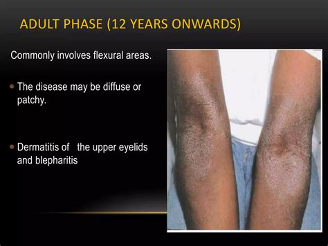 9 Eczema And Dermatitis Pptx