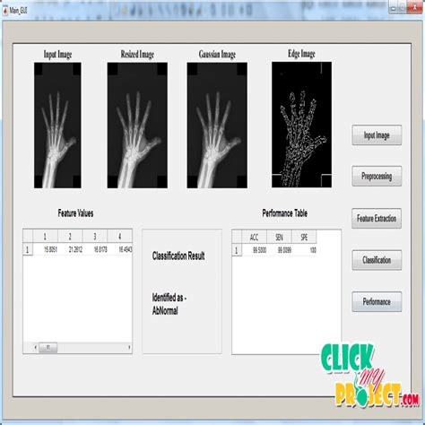 A Hybrid Two Stage Gng Modified Vgg Method For Bone X Rays