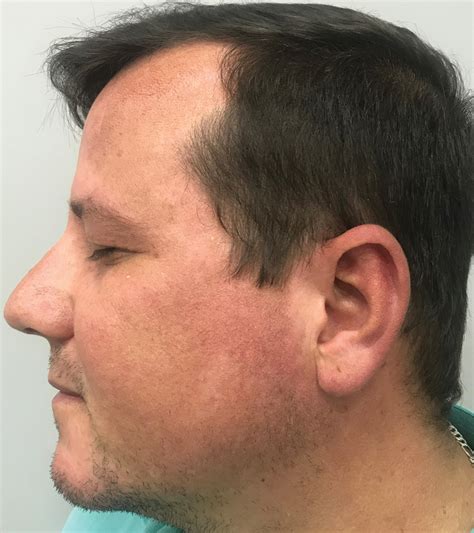 Pruritic And Pustular Eruption On The Face Mdedge