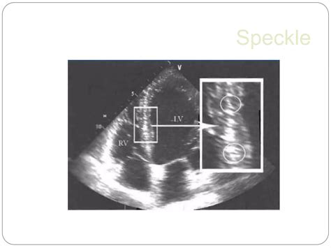 Speckle Tracking Echocardiography Pptx