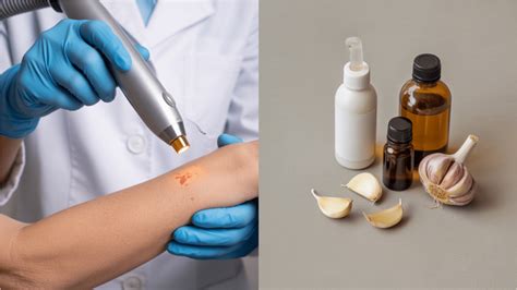 Safe And Effective Mole Removal Home Vs Professional Option Rumbie