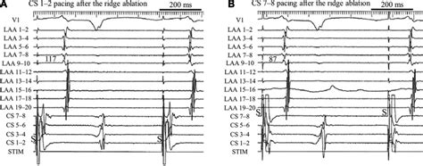 Mitral Isthmus Ablation Circulation Arrhythmia And Electrophysiology