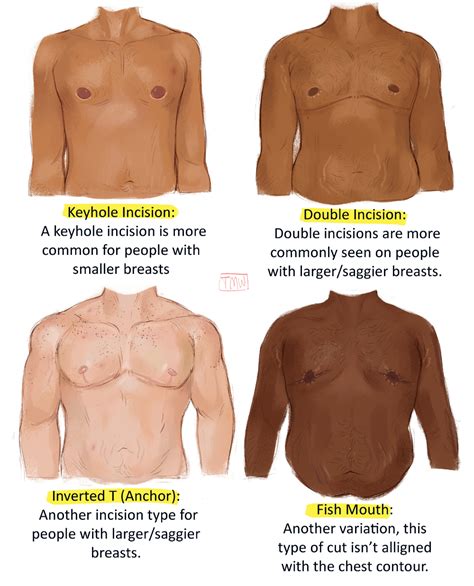 10 Trans Masc Top Surgery Scars Ideas Trans Art Surgery Scars Trans