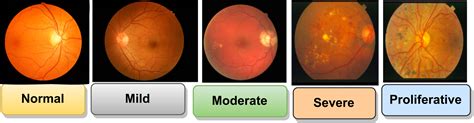 A Systematic Review On Diabetic Retinopathy Detection And Classification Based On Deep Learning