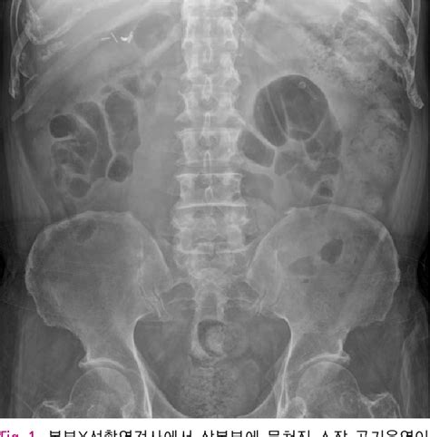Figure 1 From Inflammatory Fibroid Polyp Of Ileum With Intussusception