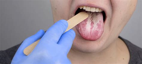 Tongue Ulcer Causes Symptoms And Treatment